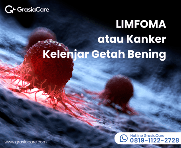 Limfoma, Pengertian, Gejala, Penyebab dan Pencegahannya – GrasiaCare